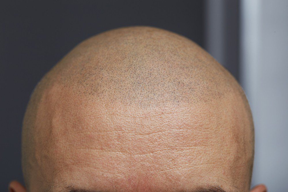 How does Hair Tattoo works for Balding Guys | SMPMobile